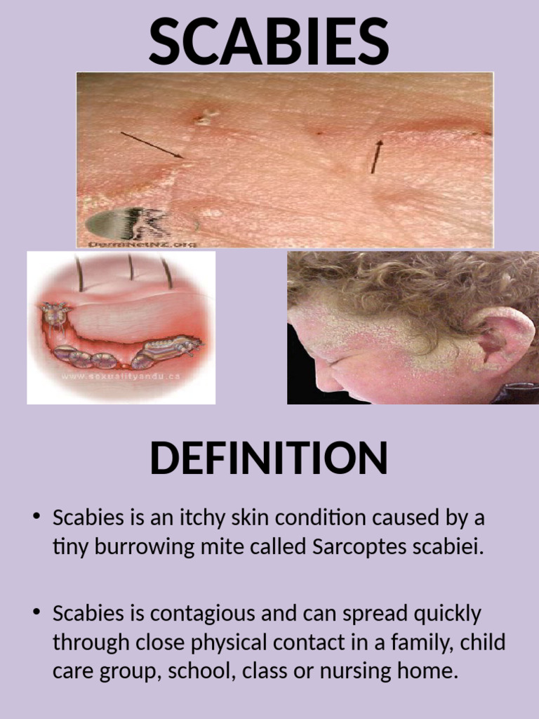 Scabies 160908065024 | PDF | Cutaneous Conditions | Dermatology