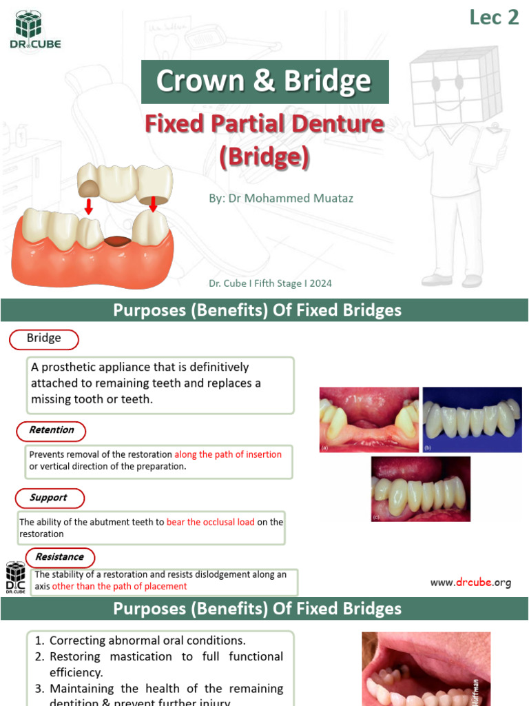 Crown & Bridge Lec.2 Fixed Partial Denture (Bridge) | PDF | Mouth | Dental Anatomy