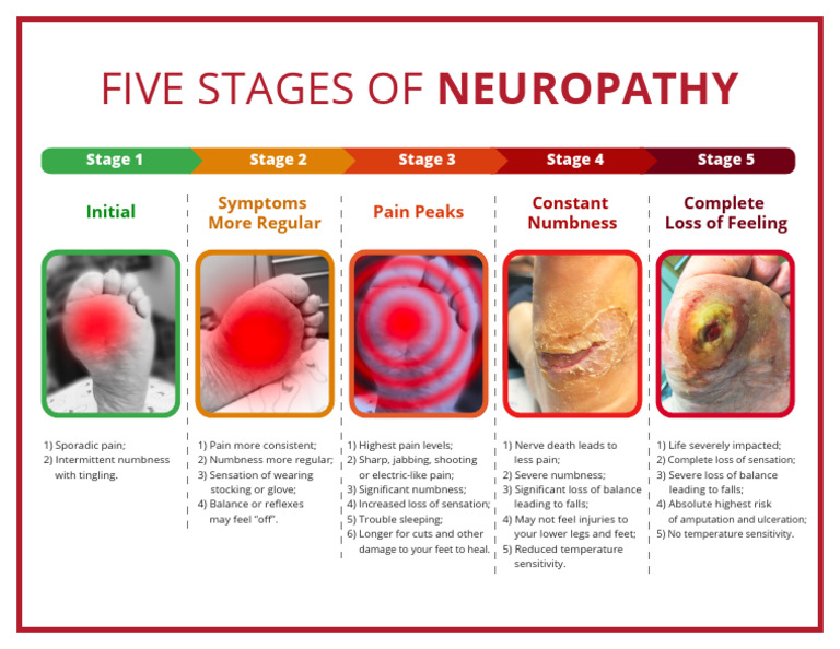 5 Stages of Neuropathy | PDF