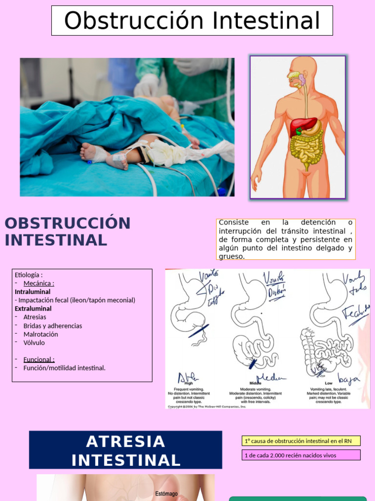 Obstruccion Intestinal Ciru 1 | PDF | Tracto gastrointestinal ...