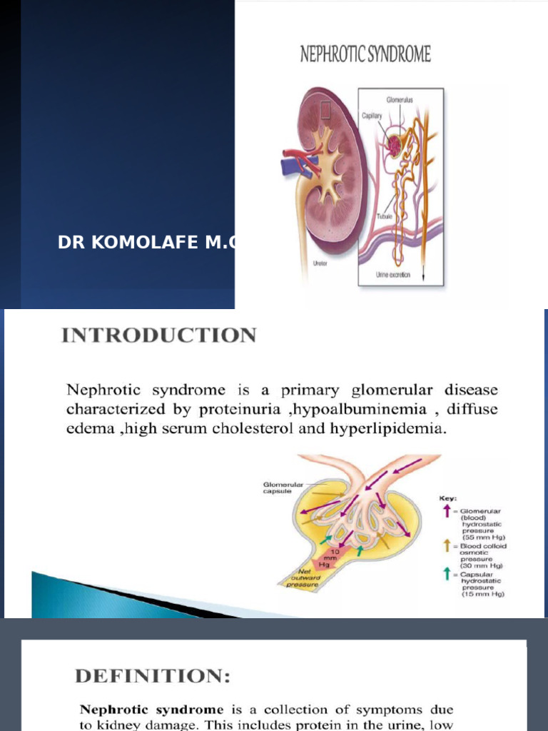 Nephrotic Syndrome | PDF
