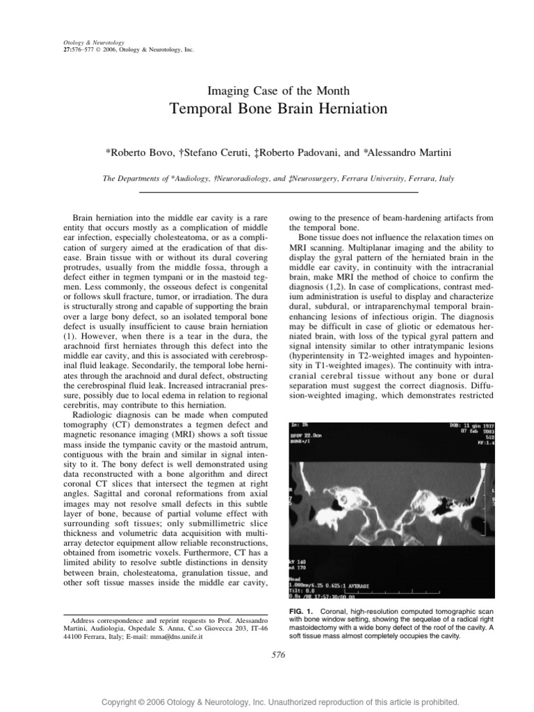 Temporal Bone Brain Herniation: Imaging Case of The Month | PDF | Ct ...
