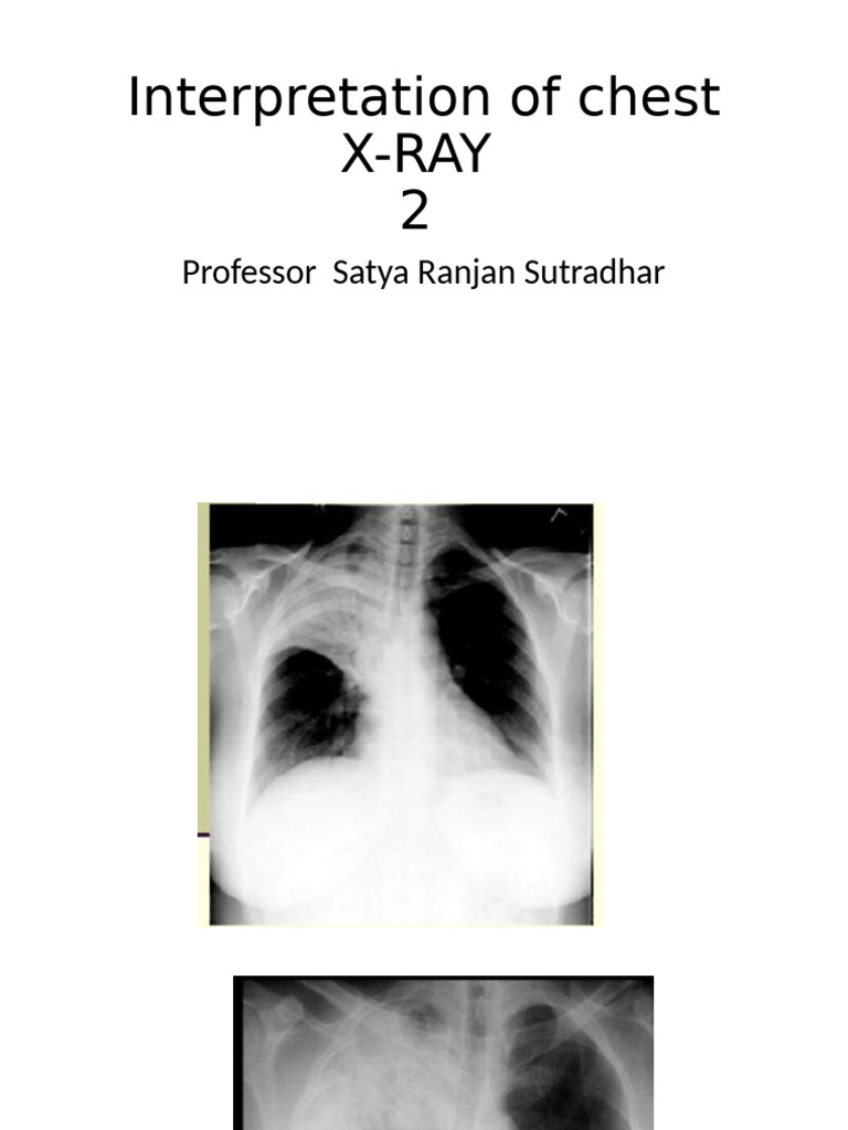 Chest X-Ray Interpretation: Pneumonia Types | PDF | Self-Improvement ...