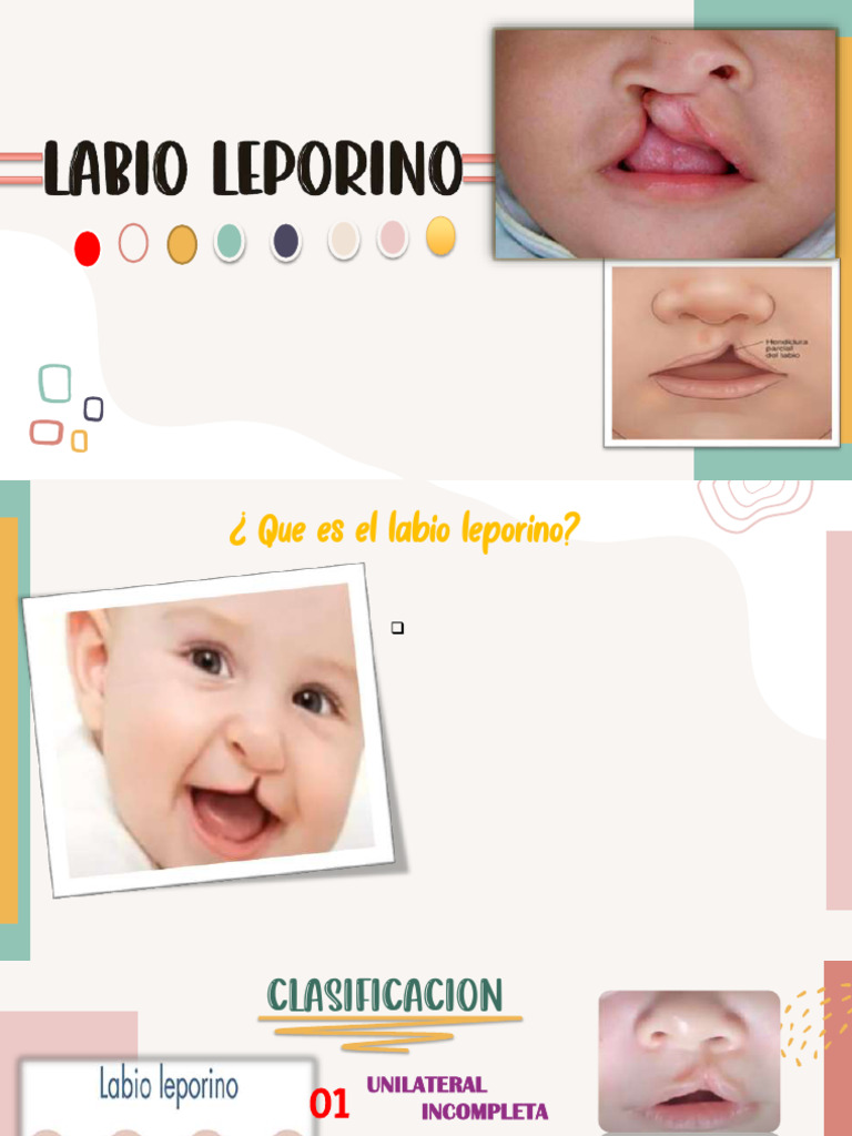 Labio Leporino: Causas y Tratamiento | PDF | Especialidades Medicas ...