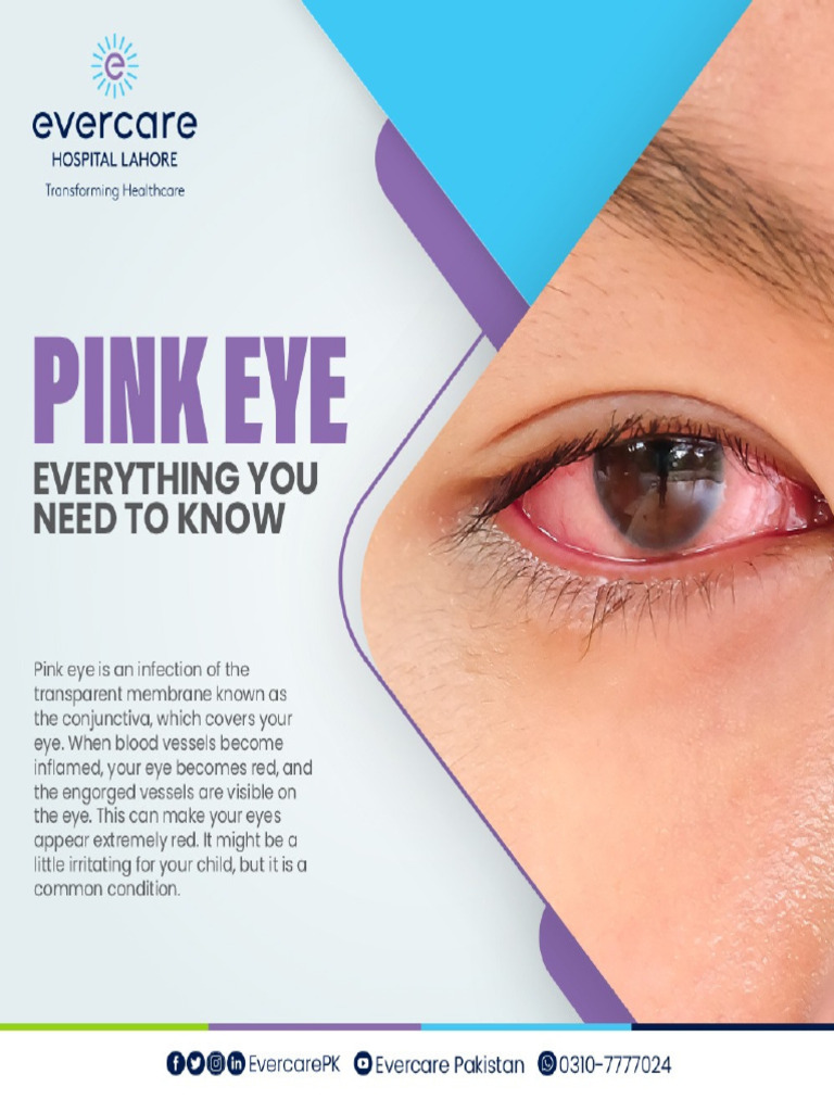 Pink Eye, Causes and Prevention | PDF