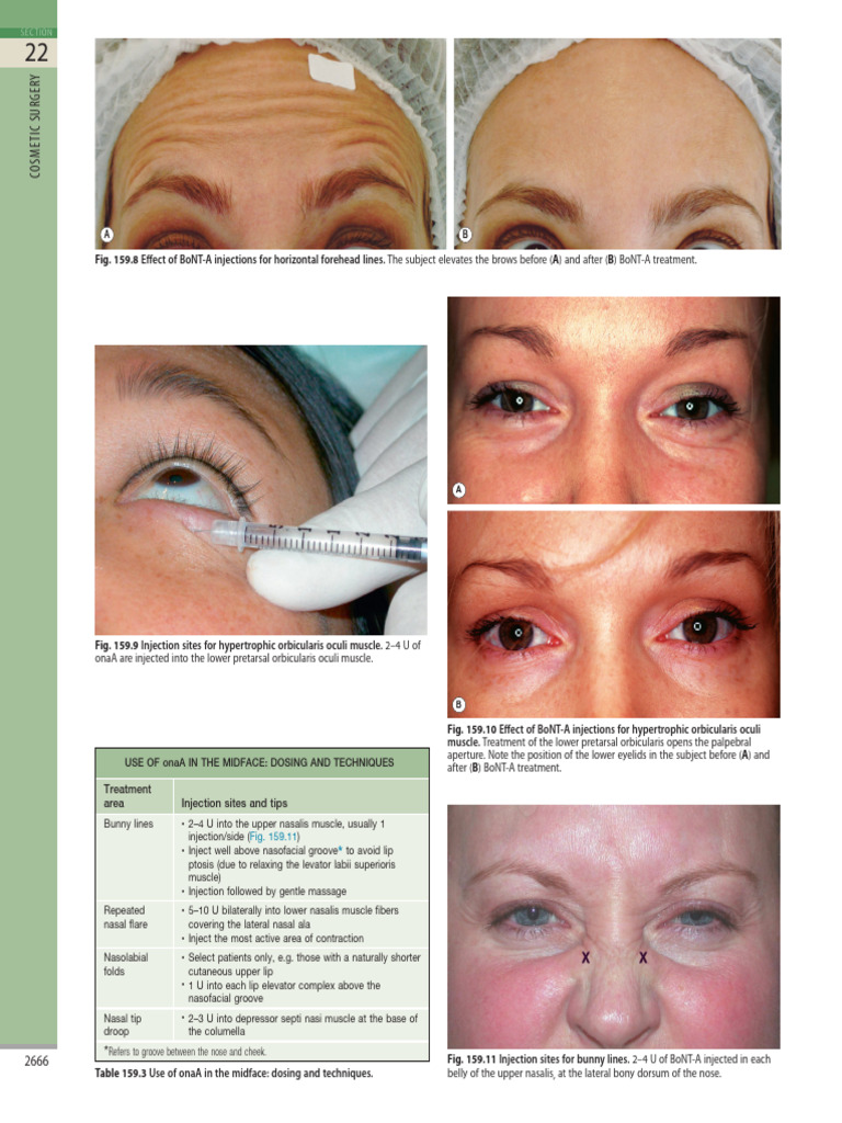 Boldano Botox Dermatologia 2 | PDF | Lip | Blood Vessel