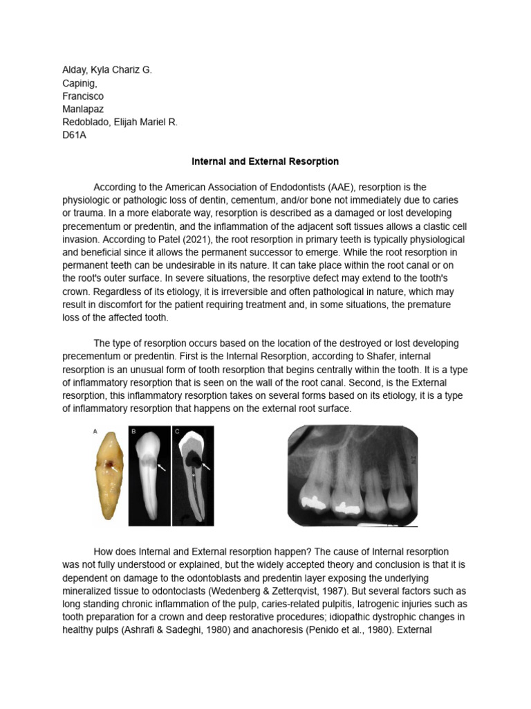 Internal-and-External-Resorption | PDF | Human Tooth | Periodontology