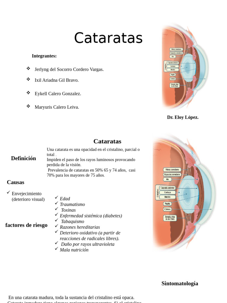 Cataratas Oftalmo | PDF | Catarata | Sistema visual