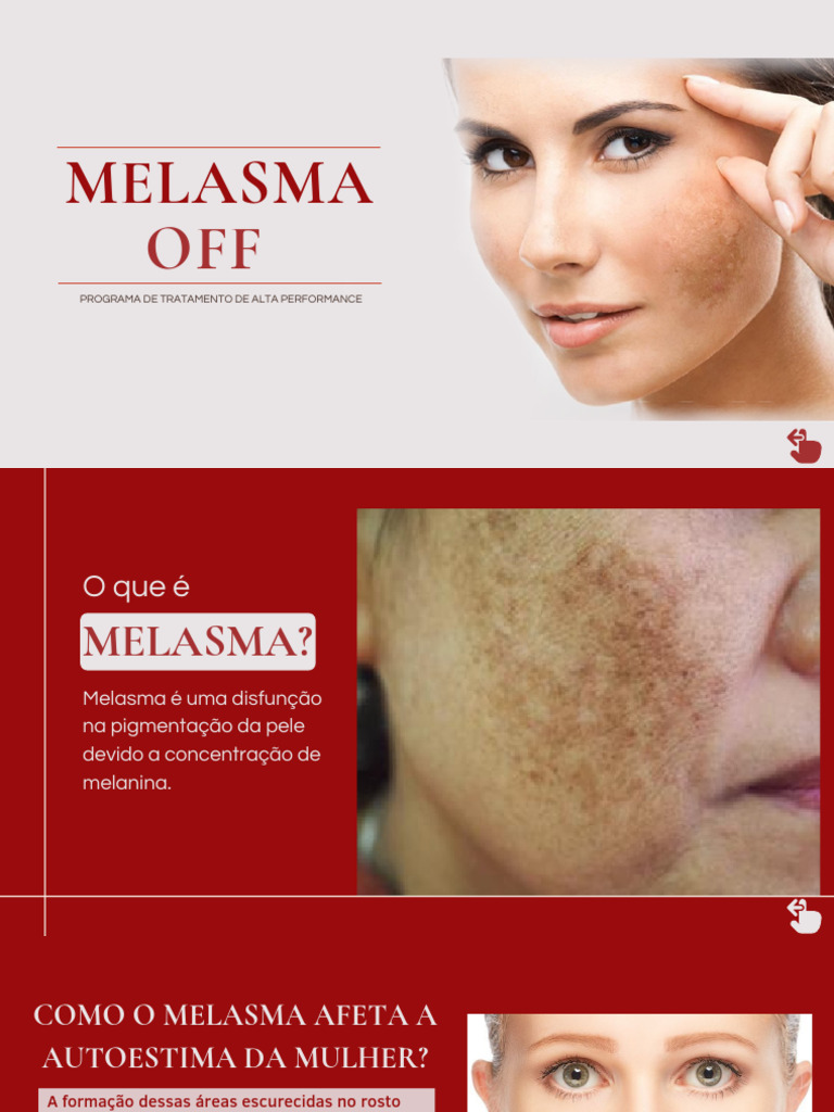 Melasma Off | PDF