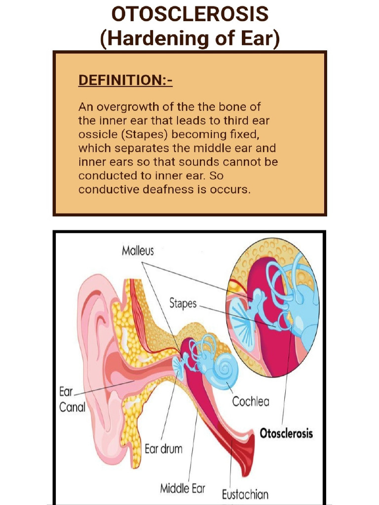 (Otosclerosis | PDF