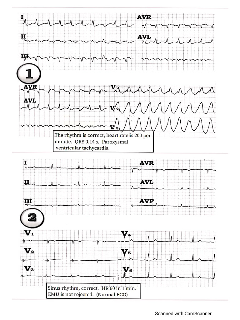 Ecgs | PDF | Heart | Electrocardiography