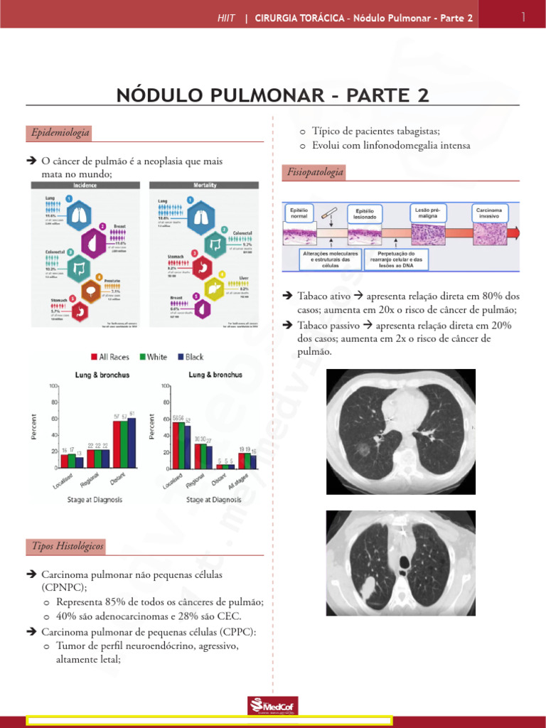 Cirurgia Toracica Nódulo Pulmonar Parte | PDF | Câncer de pulmão | Câncer