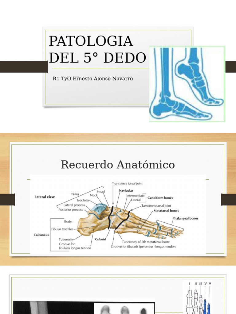 Patologia de Quinto Dedo | PDF