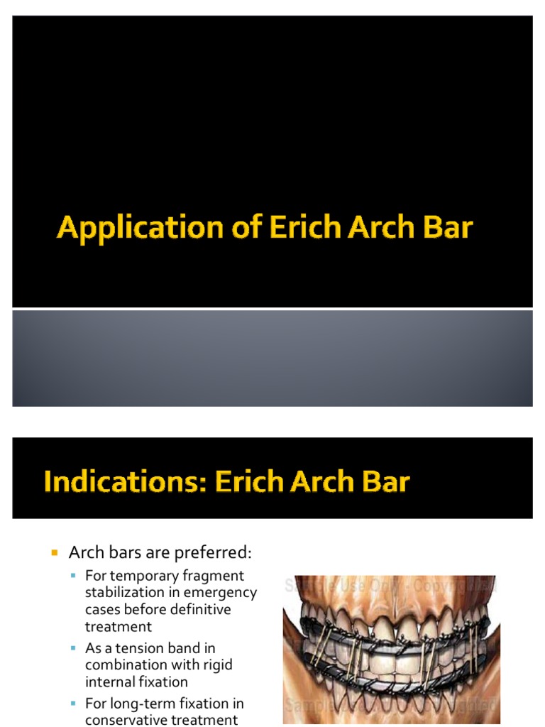 Application of Erich Arch Bar | Tooth | Mouth