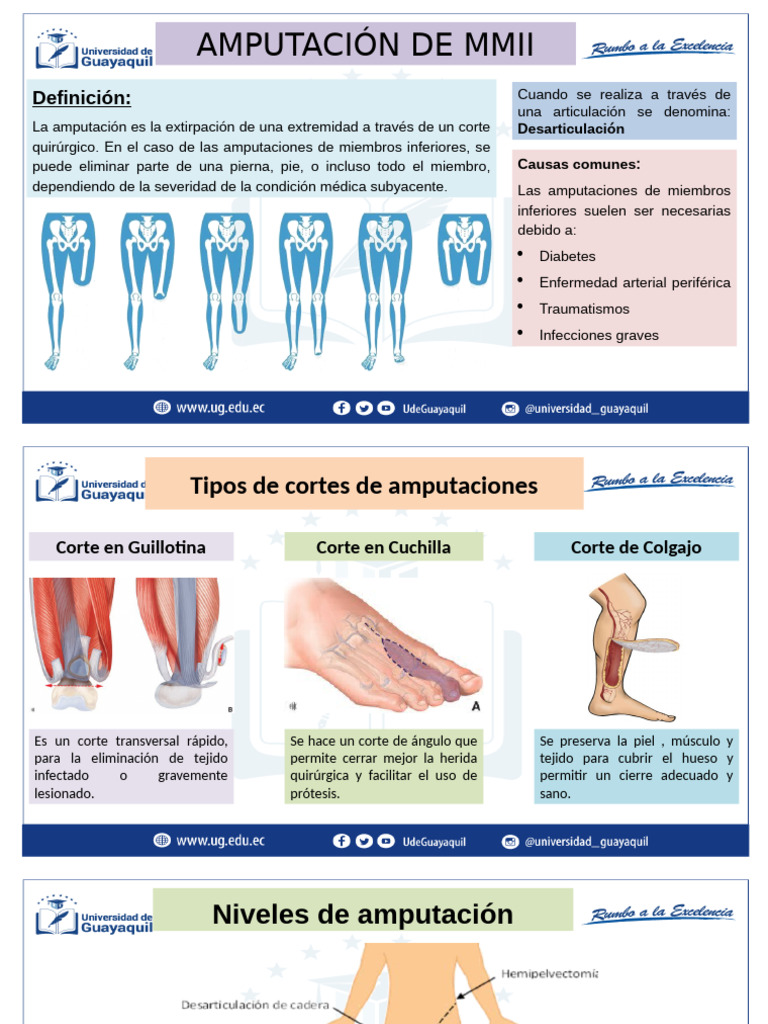 Tipos y técnicas de amputación de MMII | PDF | Rodilla | Amputación
