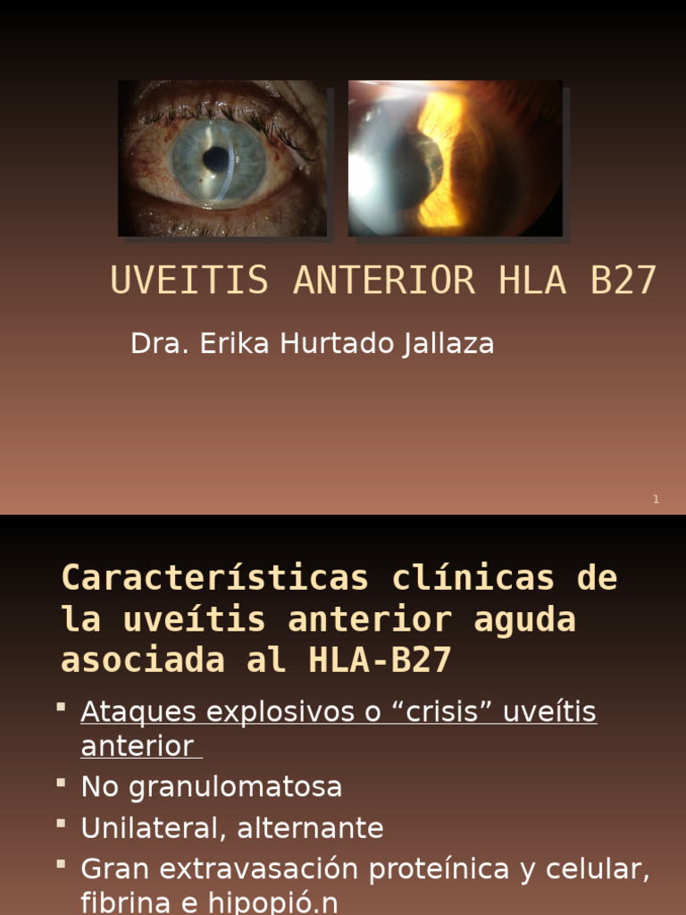1er Calse B-Uveitis Anterior Hla b27 | PDF | Medicina CLINICA | Ojo humano