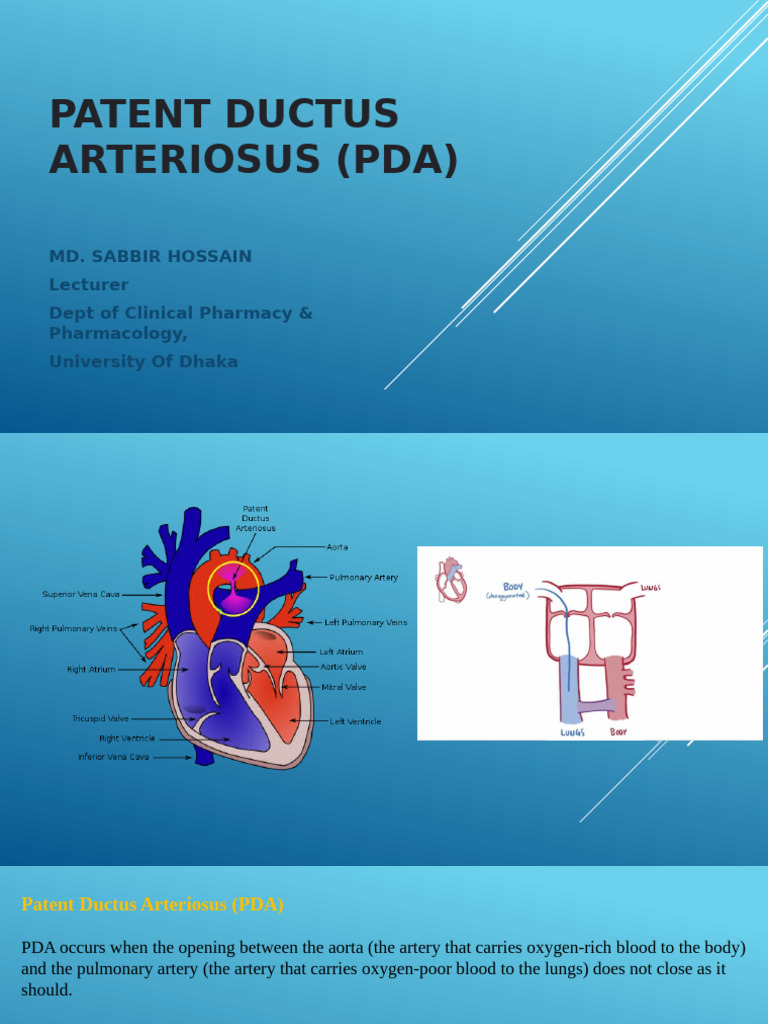 Patent Ductus Arteriosus (PDA) | PDF | Fetus | Heart