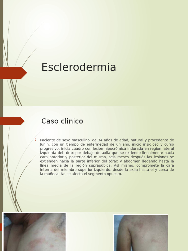 Esclerodermia 170130022344 | PDF | Causas de la muerte | Especialidades ...