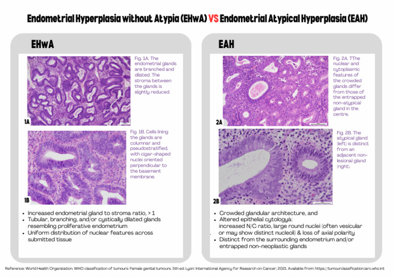 Endometrial Hyperplasia Types Explained | PDF | Epithelium | Medical ...