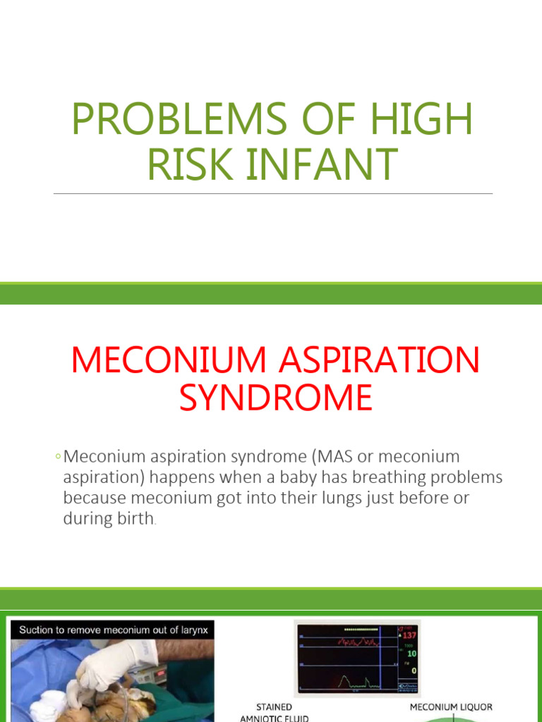 Meconium Aspiration Syndrome in Infants | PDF