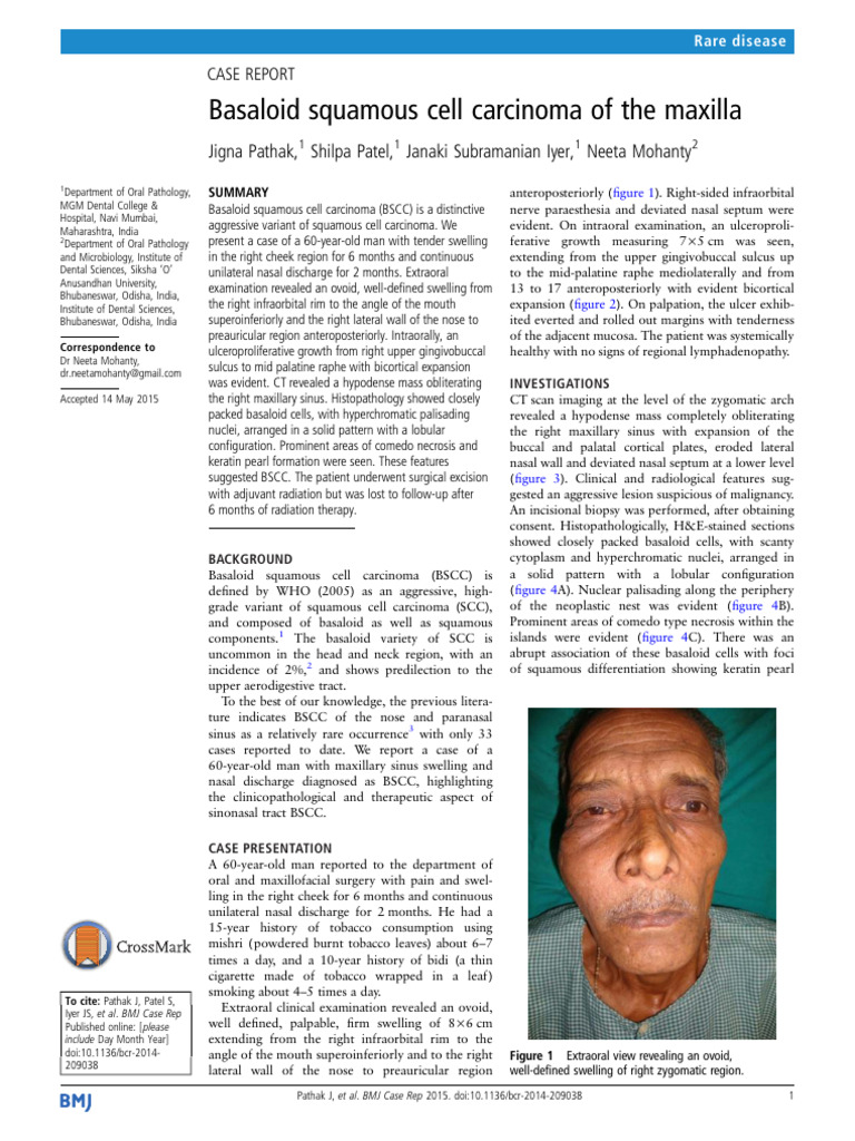 Basaloid Squamous Cell Carcinoma of The Maxilla. | PDF | Human Nose ...