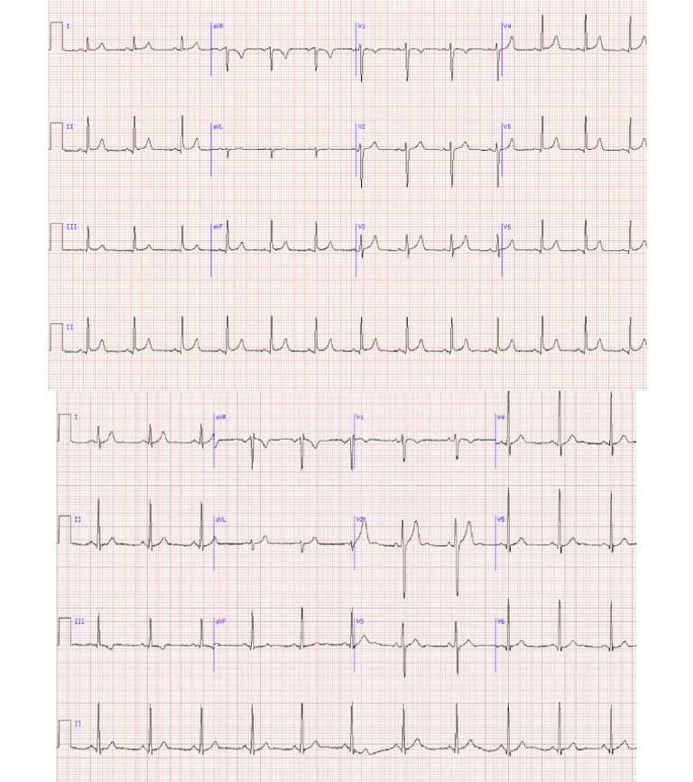 ECG1 2 230522 | PDF