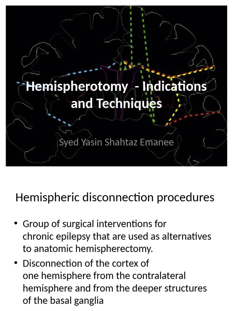 Hemispherotomy Techniques and Indications | PDF | Epilepsy | Cerebral ...