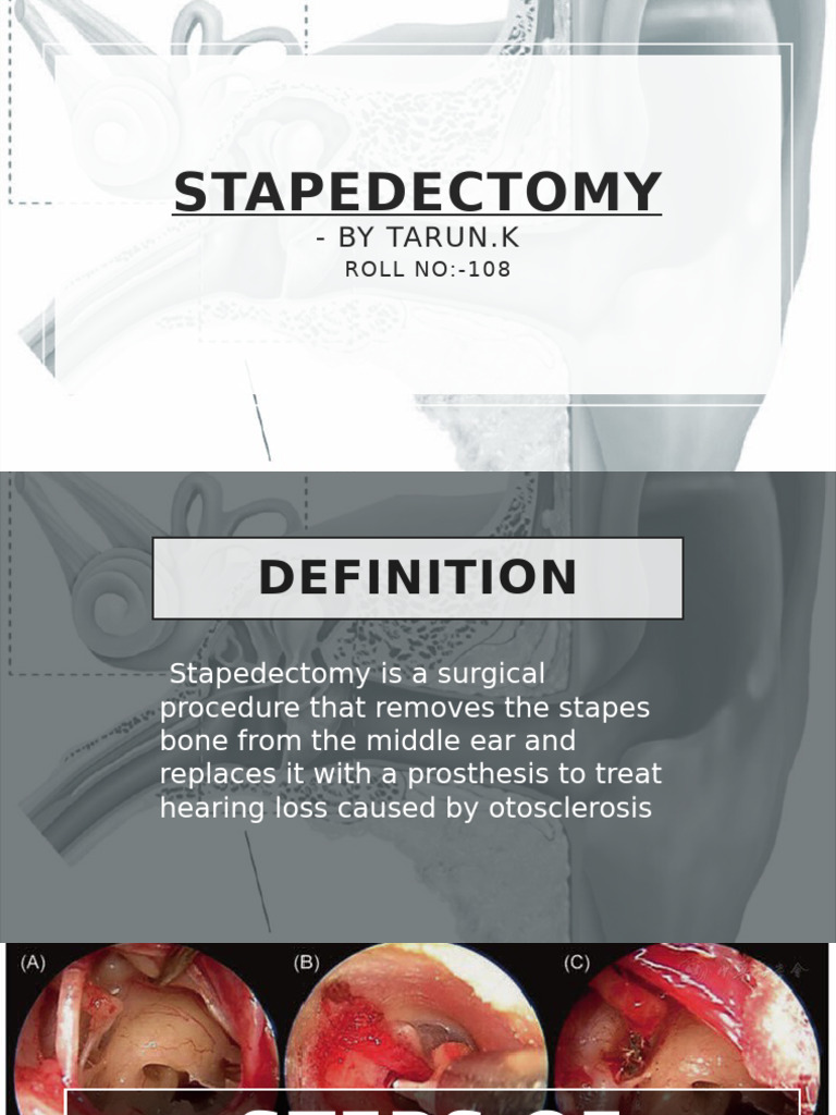 Stapedectomy | PDF