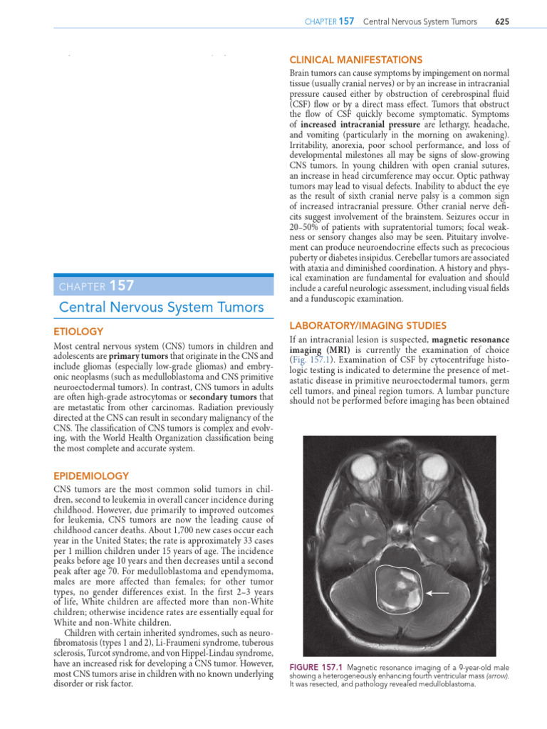 Nelson 2023 pediatría esencia -765-774 | PDF | Brain Tumor | Glioma