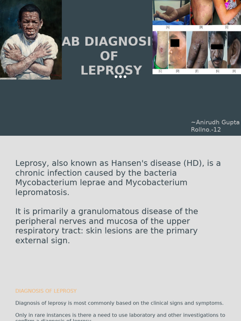 Leprosy | PDF | Leprosy | Medical Specialties