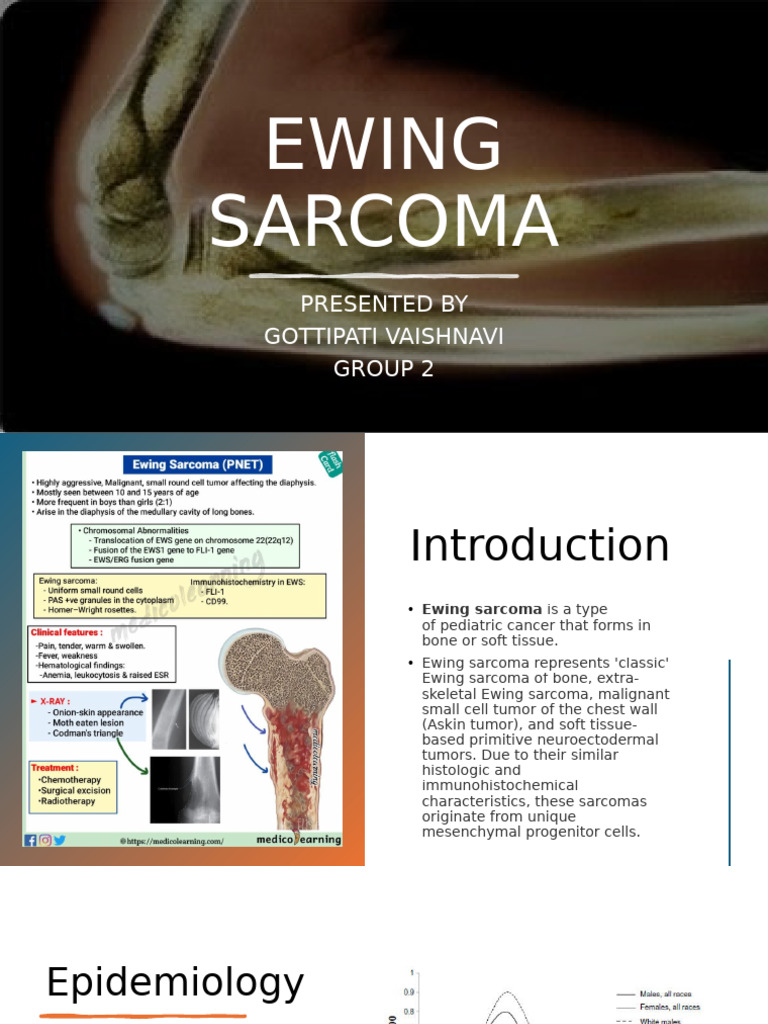 Ewing Sarcoma - Gottipati Vaishnavi, Group 2 | PDF | Sarcoma | Chemotherapy