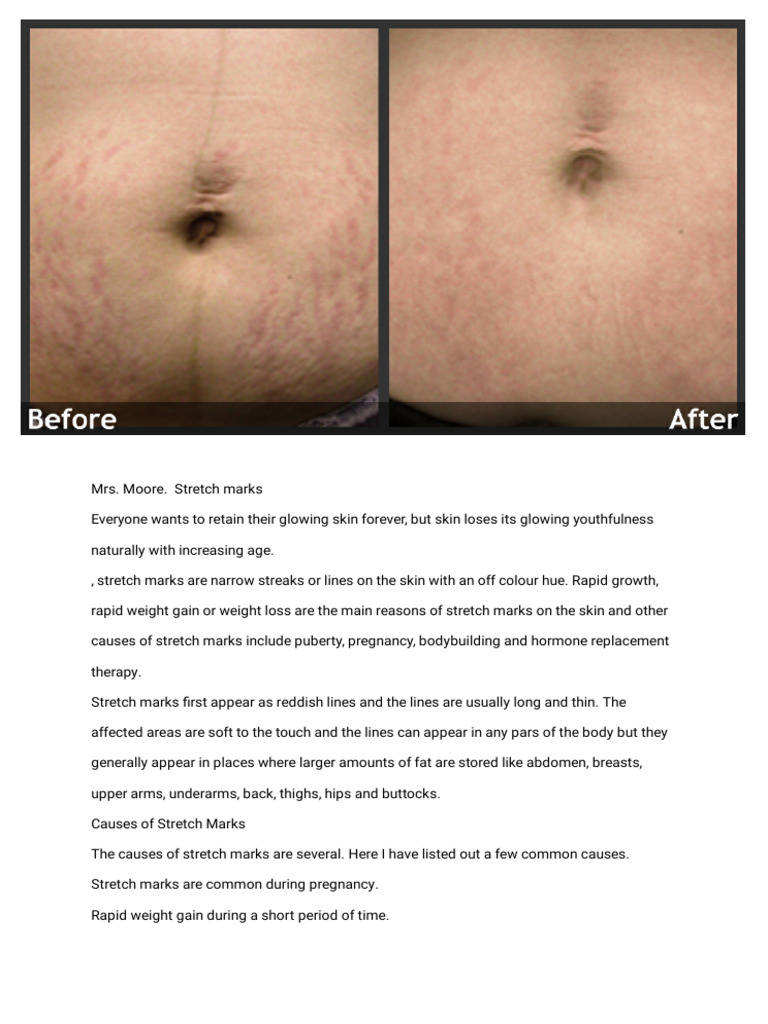 Stretch Marks | PDF | Collagen