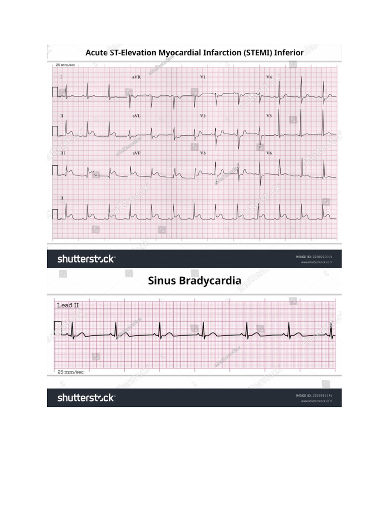 EKG | PDF