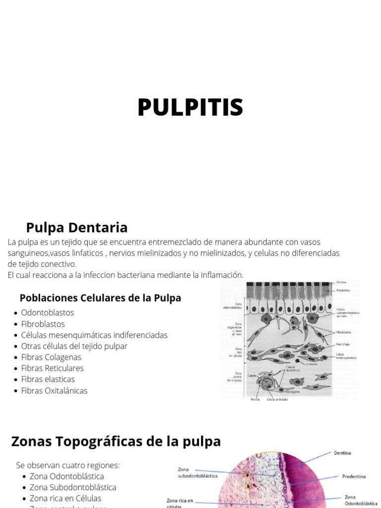 Pulpitis Reversible: Causas y Tratamientos | PDF | Inflamación ...