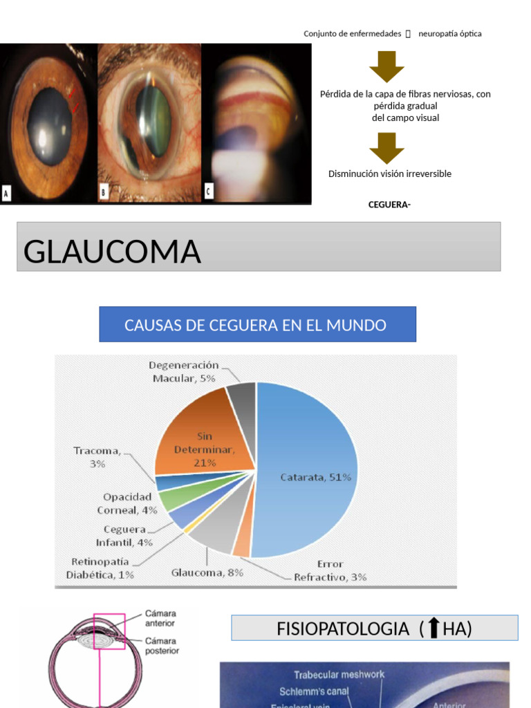 Glaucoma y Catarata | PDF | Glaucoma | Catarata