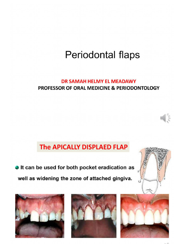 (Year 4) Periodontology Lecture - Periodontal Flaps Part 2 | PDF