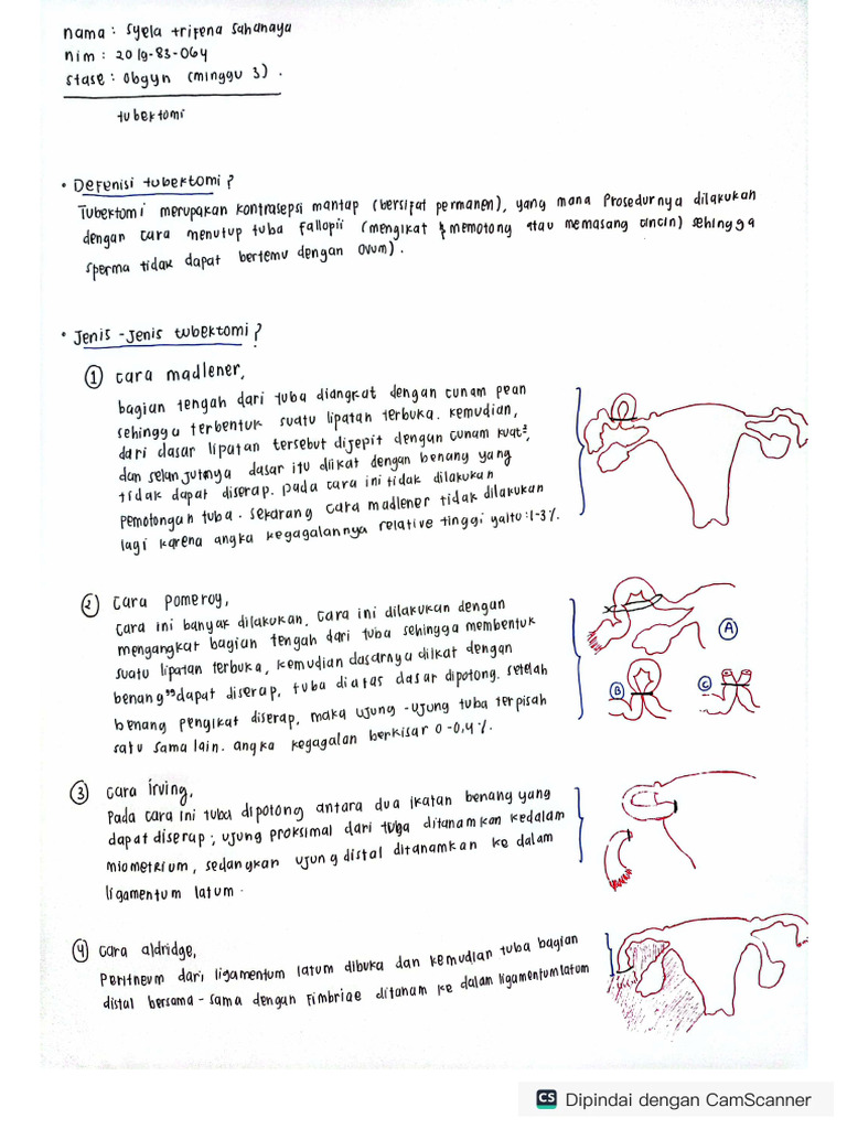 Tugas Obgyn - Syela Trifena - Tubektomi | PDF