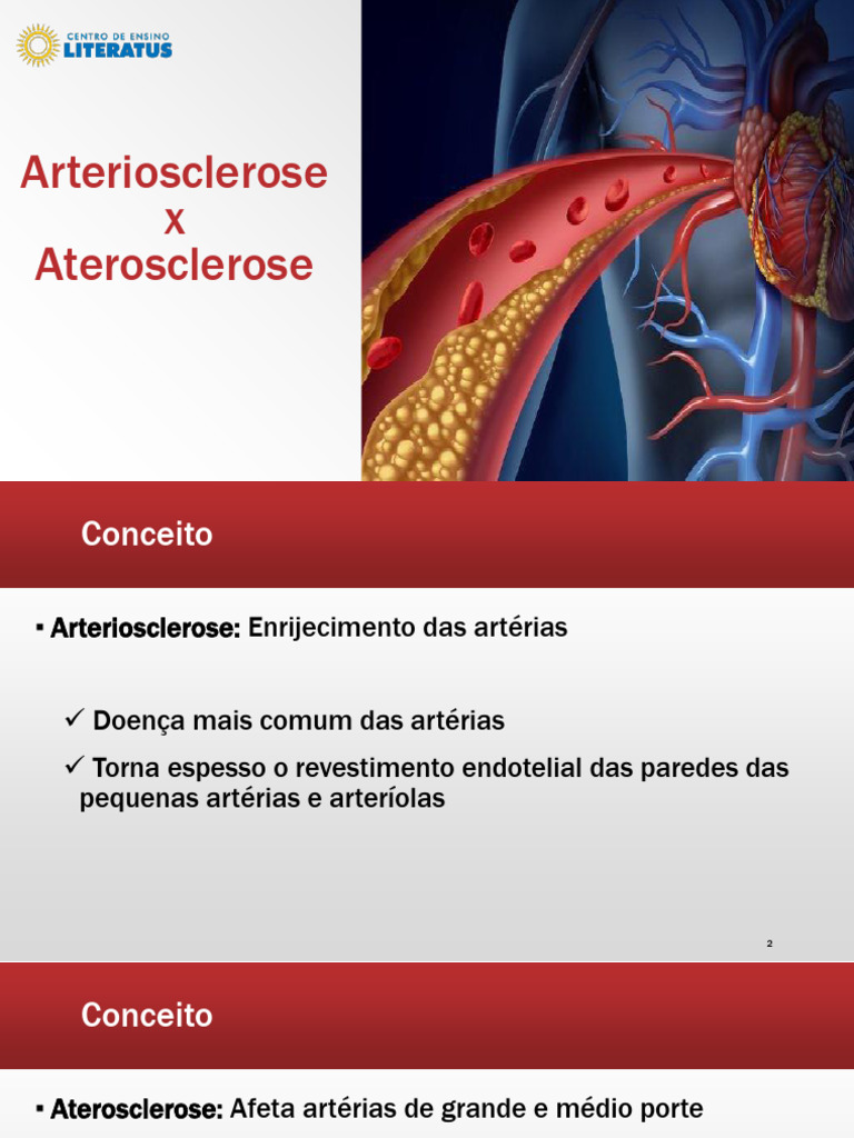 Aula 05 Aterosclerose e Arteriosclerose | PDF