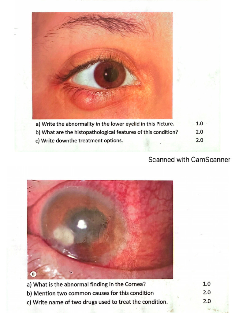Eye Ospe Final | PDF