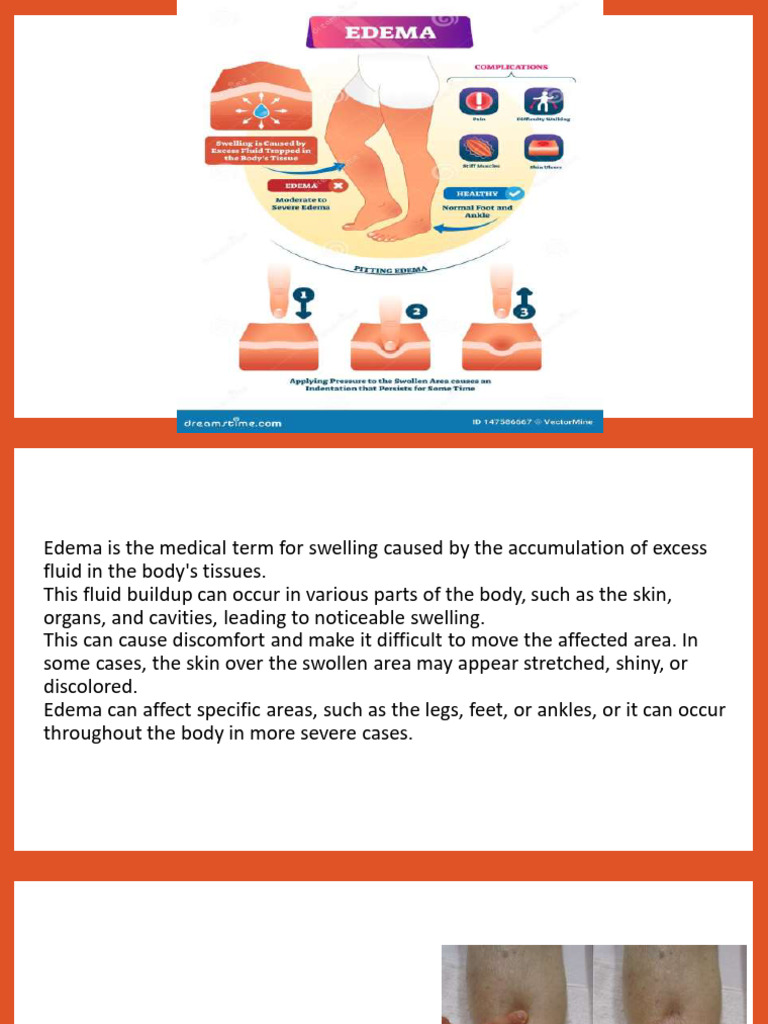 Edema | PDF | Edema | Medical Specialties