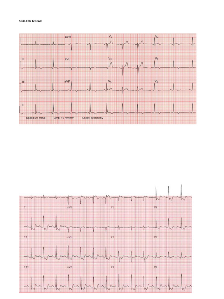 EKG 12 Lead | PDF