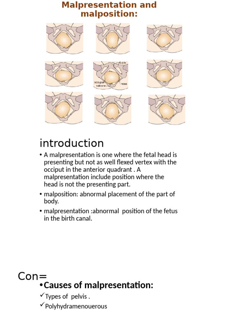 Malpresentation and Malposition | PDF | Childbirth | Maternal Health