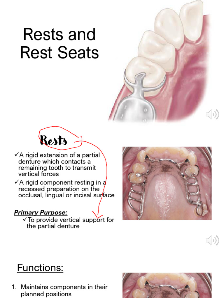 RPD Rests and Rest Seats | PDF | Dentistry Branches