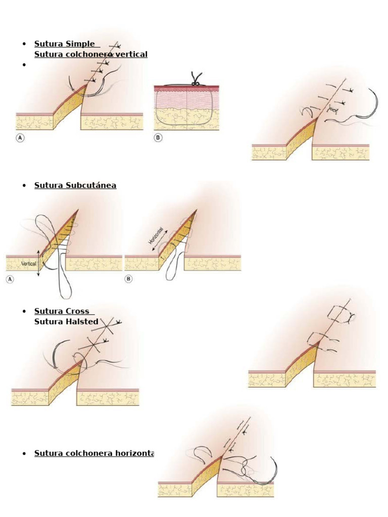 Sutura Simple Sutura colchonero vertical | PDF