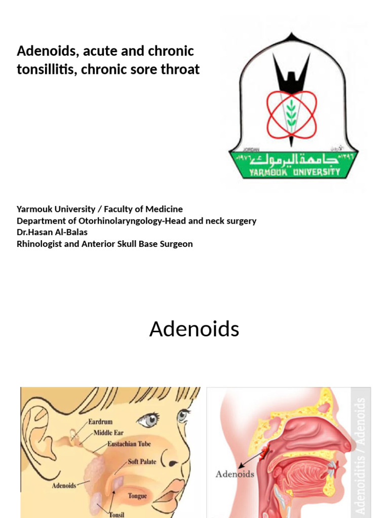Adenoids, Acute and Chronic Tonsillitis, Chronic Sore Throat Dr. Hasan | PDF | Human Nose ...
