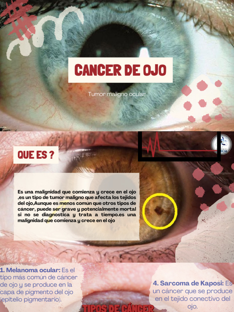 Cáncer Del Ojo - 20241027 - 161227 - 0000 | PDF | Cáncer | Ojo
