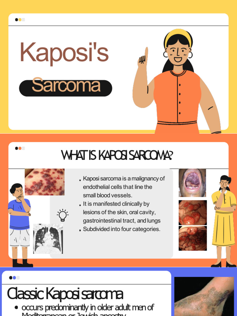 Kaposis Sarcoma (Autosaved) | PDF | Sarcoma | Neoplasms