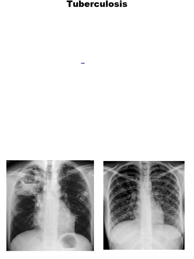 Gram +ve and Gram-Ve Inf | PDF | Tuberculosis | Immunology