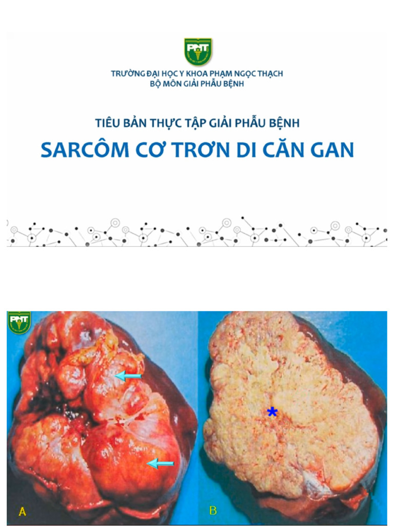 Sarcom Cơ Trơn Di Căn Gan | PDF