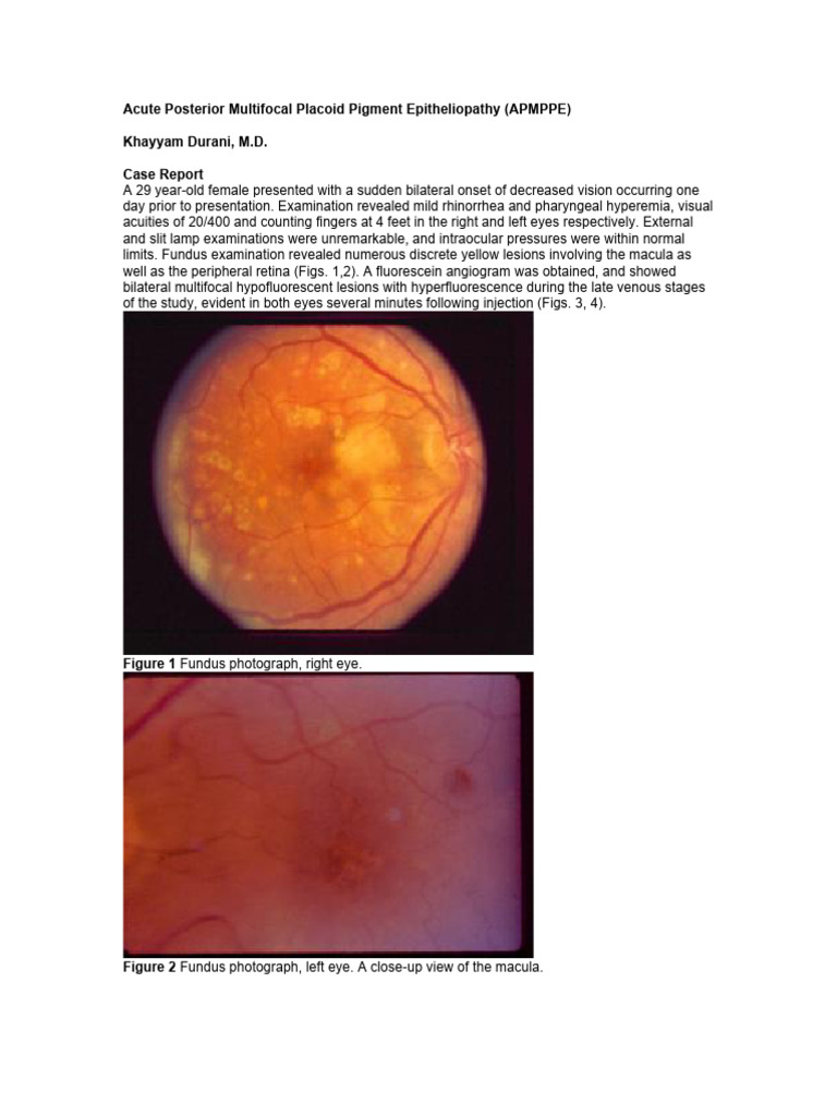 Acute Posterior Multifocal Placoid Pigment Epitheliopathy | PDF ...